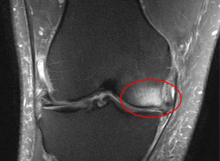 Tenotomy Procedure - Susquehanna Orthopaedic Associates